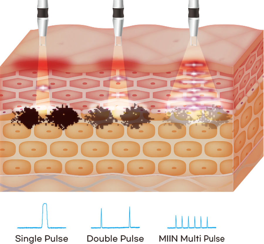 LTRA MIIN Laser – AexelBioMed