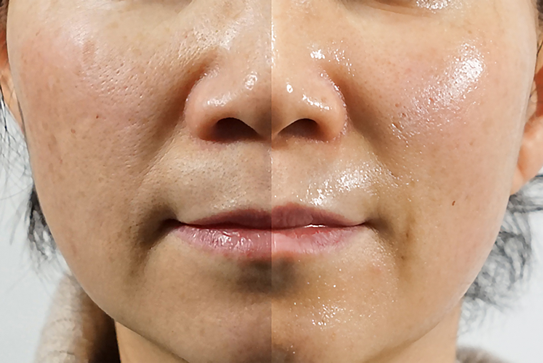 LHA LALA - AexelBioMed